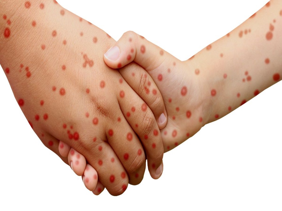 Campak: Bahaya, Penyebaran, dan Langkah Pencegahan Efektif - Sahabat Sehat